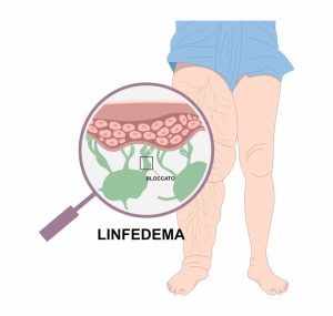 Linfedema alle gambe: sintomi, cause e trattamenti efficaci